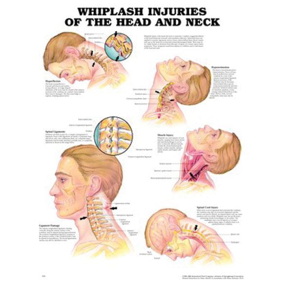 Whiplash Injuries of the Head and Neck Anatomical Chart | OPC Health
